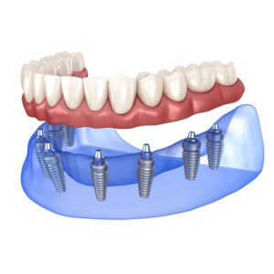 Full Arch Dental Implants: A Comprehensive Guide